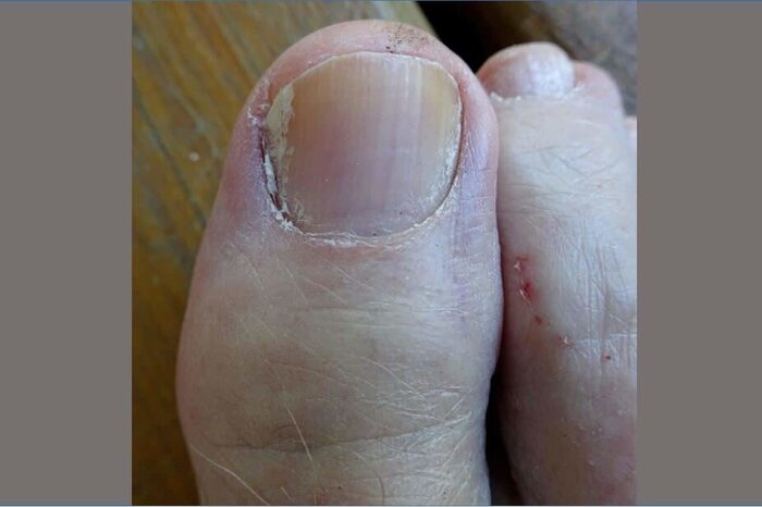 Signes d’alerte du début d’une mycose sur un ongle de pied