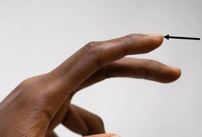 Hyponychium douloureux : causes et traitements