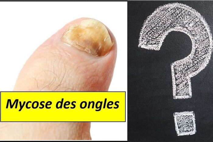 Mycose des ongles ou onychomycose : Le Guide complet
