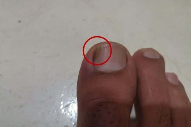 Mycose d’ongle pied qui ne part pas : voilà quoi faire