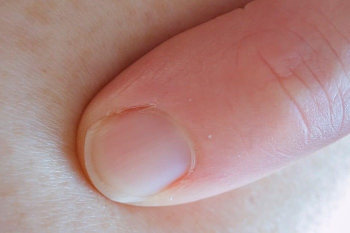 Ongle et peau qui gratte : tout sur la paronychie