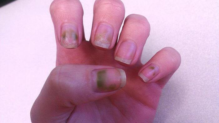 Ongle vert après faux ongles : Causes et traitement
